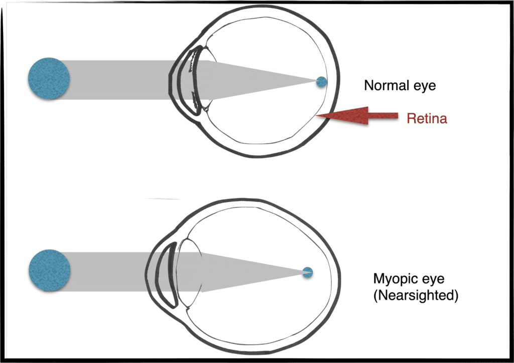 What Is Myopia | Honolulu Eye Clinic